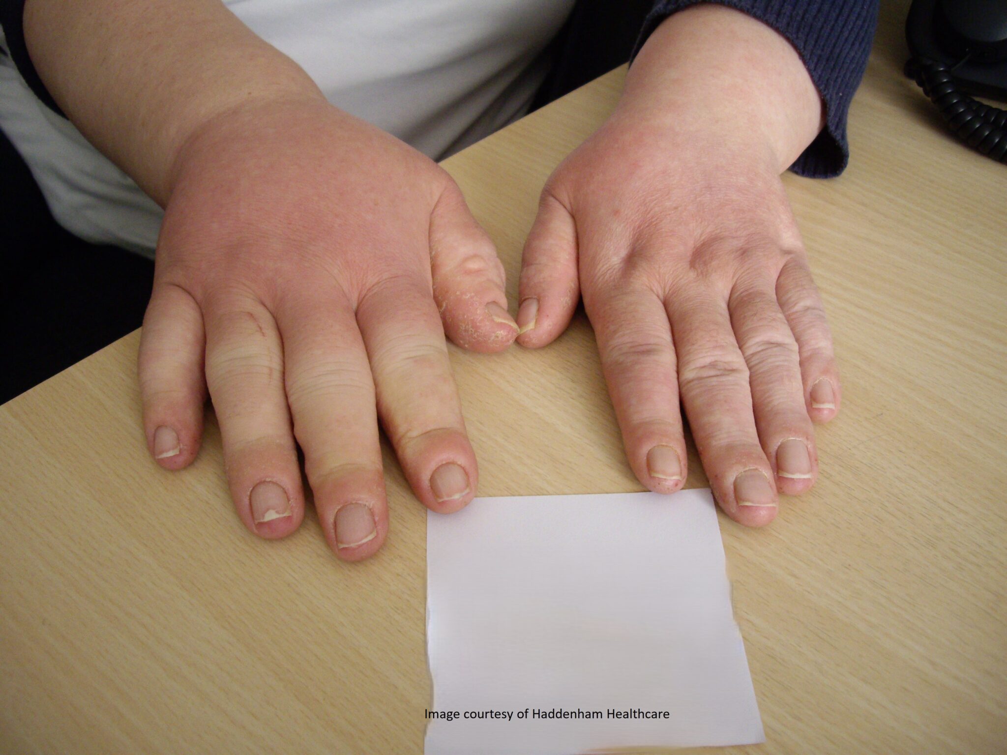 Breast Cancer related lymphoedema; including lymphoedema of the arm ...