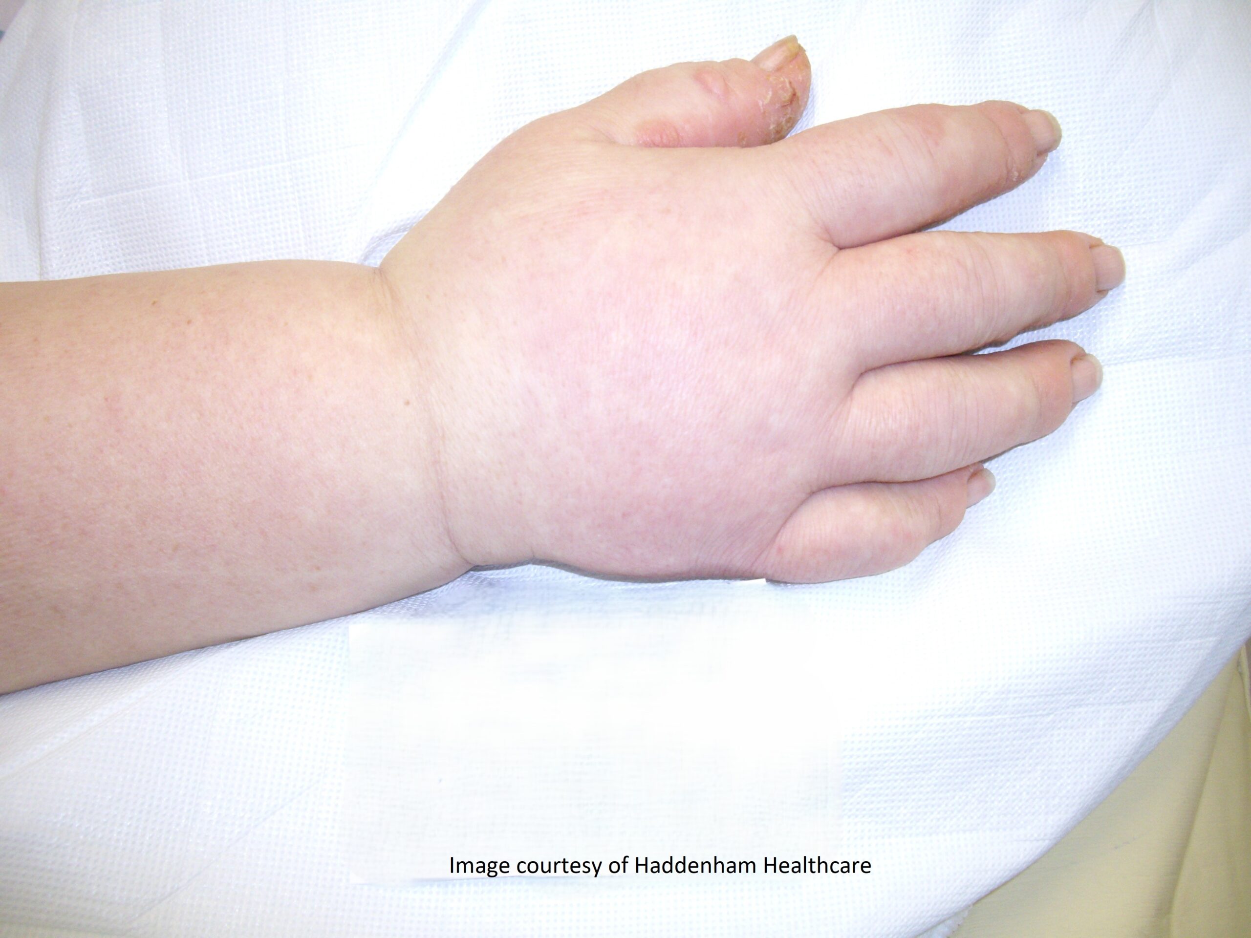 Skin cancer; including upper and lower limb and trunk oedema ...